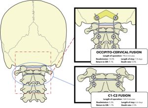 C1-C2 Fusion - Dr. Nikhil Malewar