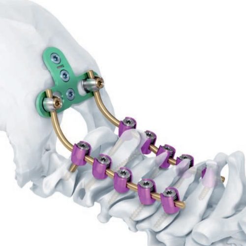Occipitocervical Fusion - Dr. Nikhil Malewar